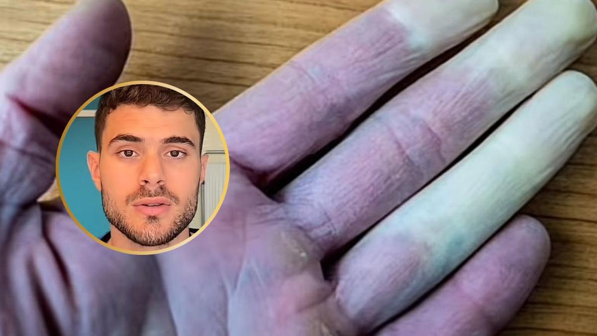 Sí, que tus dedos se vuelvan blancos y luego rojos en invierno tiene ...