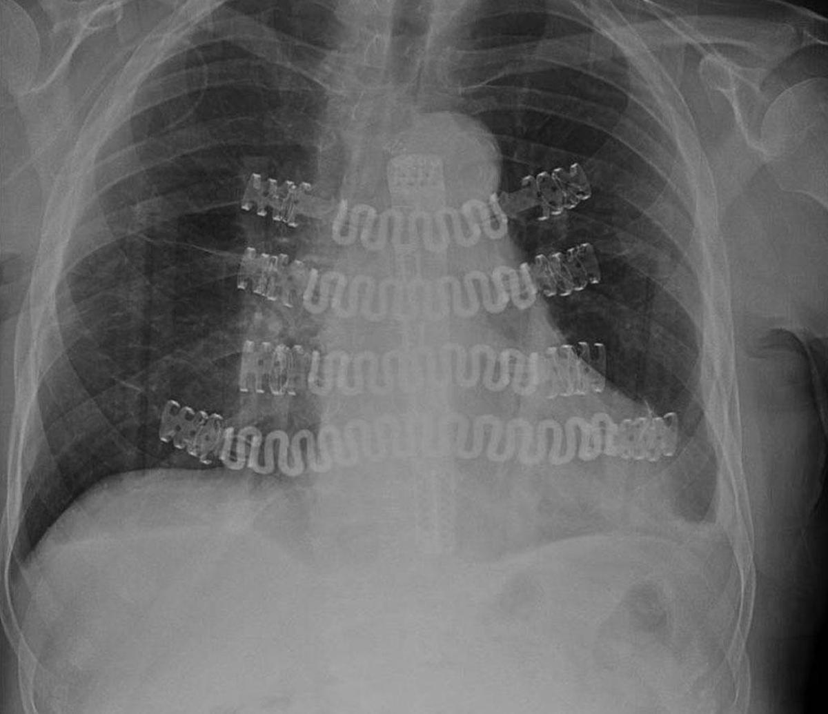 Implantan una prótesis de esternón y costillas diseñada con tecnología 3D