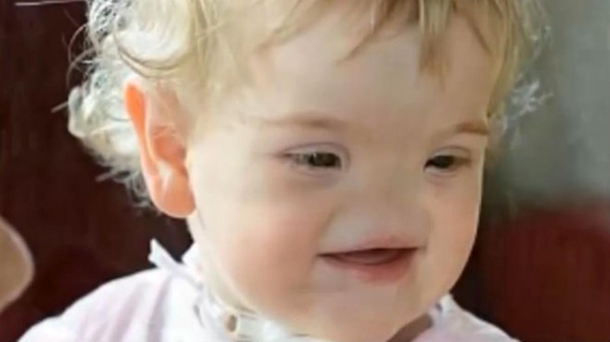Una niña de dos años afectada de arrinia tendrá nariz gracias a una ...