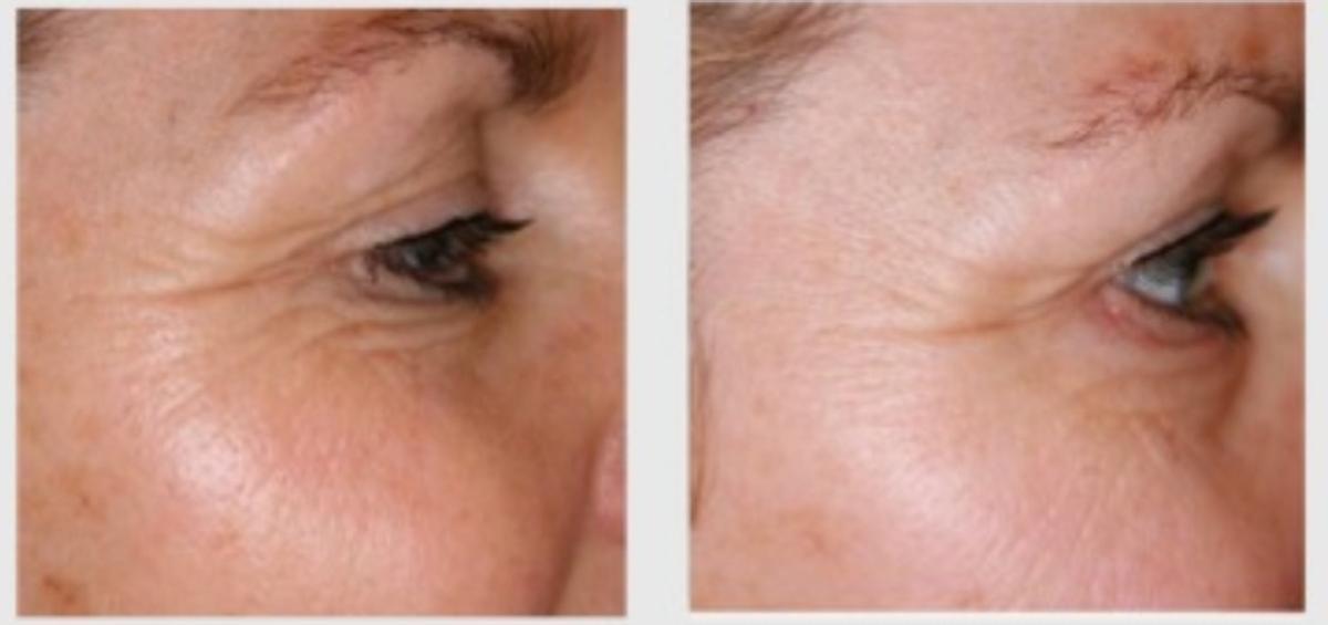 Marisa Tirado amplía su unidad láser con equipos de vanguardia