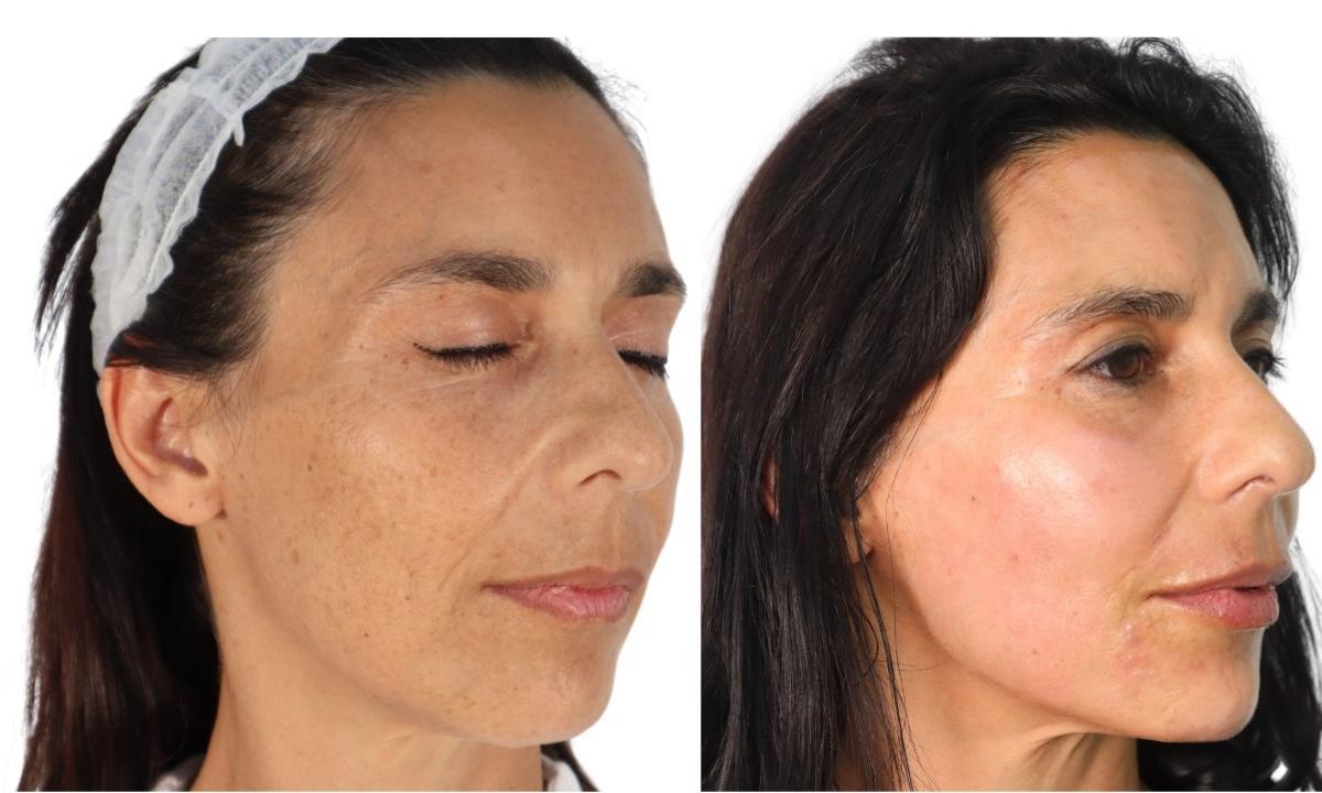Clínica Dra. Yasmin Al Adib en Ibiza: armonización facial y láser para ...