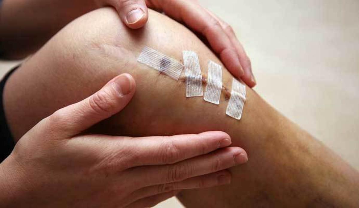 Claves para cuidar una cicatriz