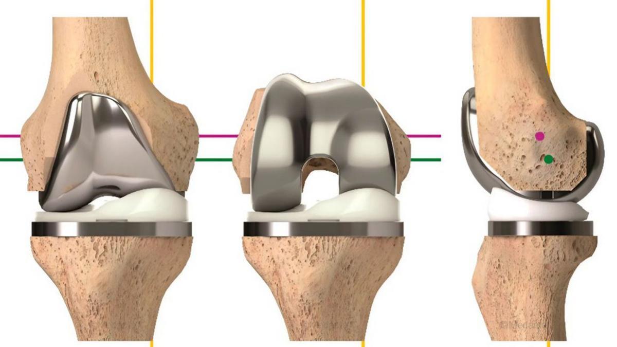 Cirugía personalizada de la rodilla: ¿Mito o realidad? - La Opinión de ...