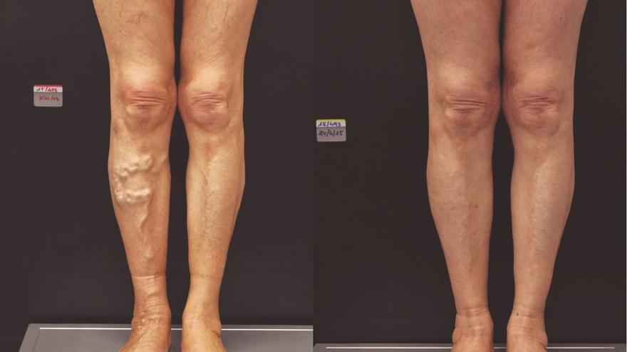 El adiós a la cirugía de las varices - Faro de Vigo