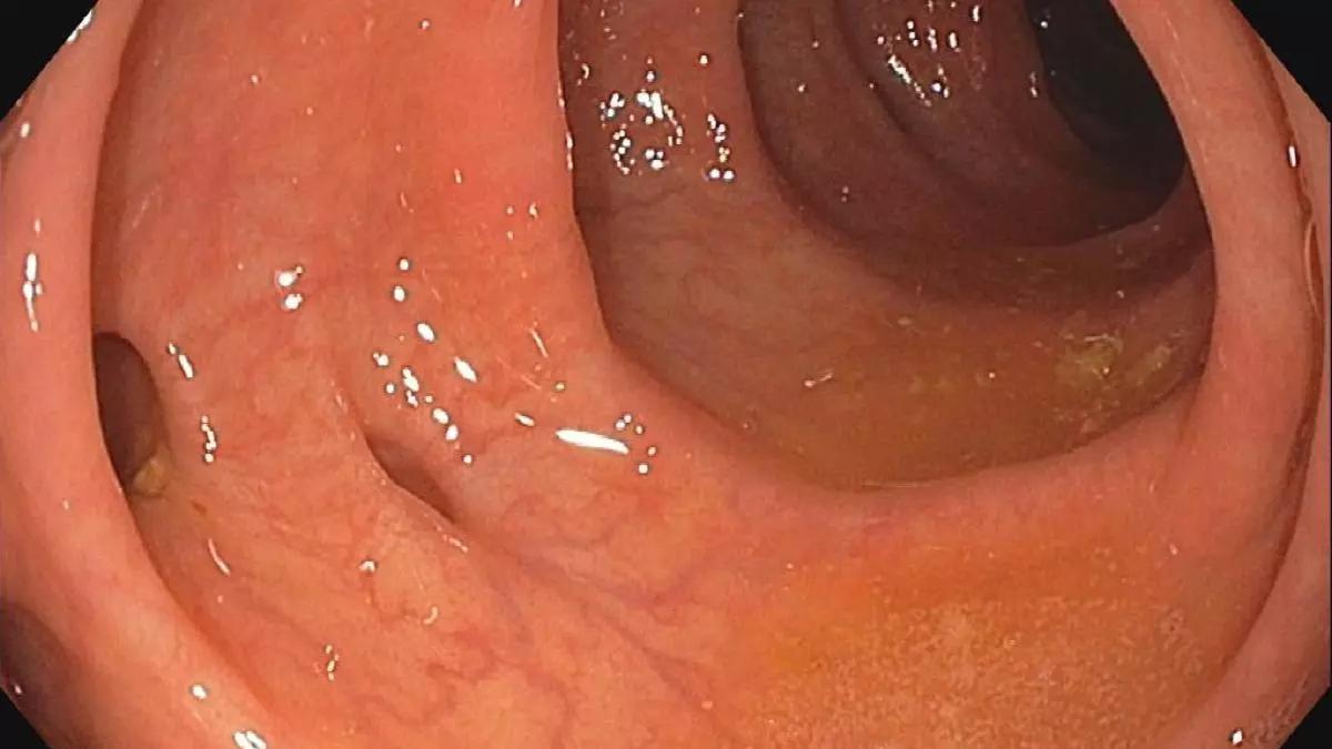 Divertículos en el colon: Qué son, cómo prevenirlos, sus síntomas y ...