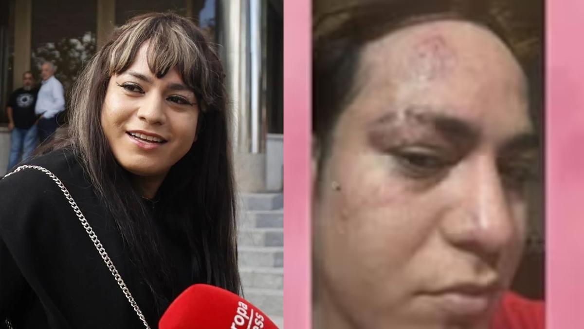 Valeri Cuéllar muestra la agresión que sufrió en su domicilio tras un ...