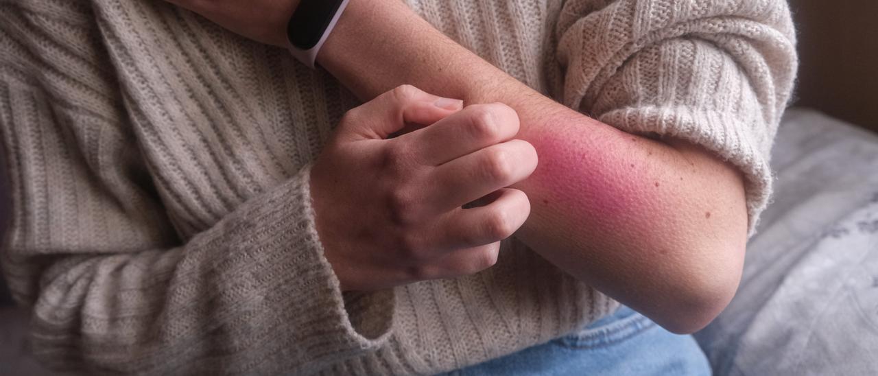 La sarna se cura con una pastilla y una pomada