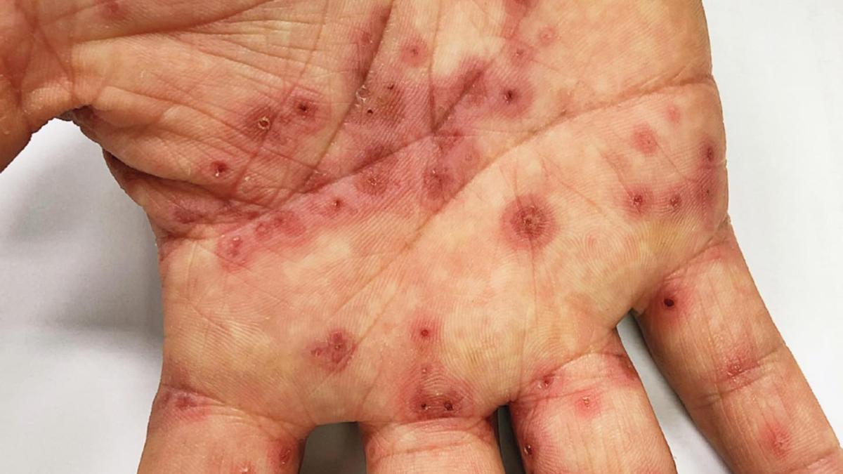 Fotos Eritema Multiforme: ¿Urticaria o nuevo efecto de la vacuna del covid?