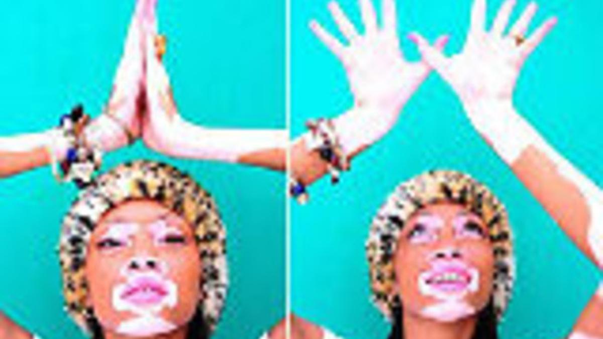 Winnie Harlow, la primera modelo con vitiligo