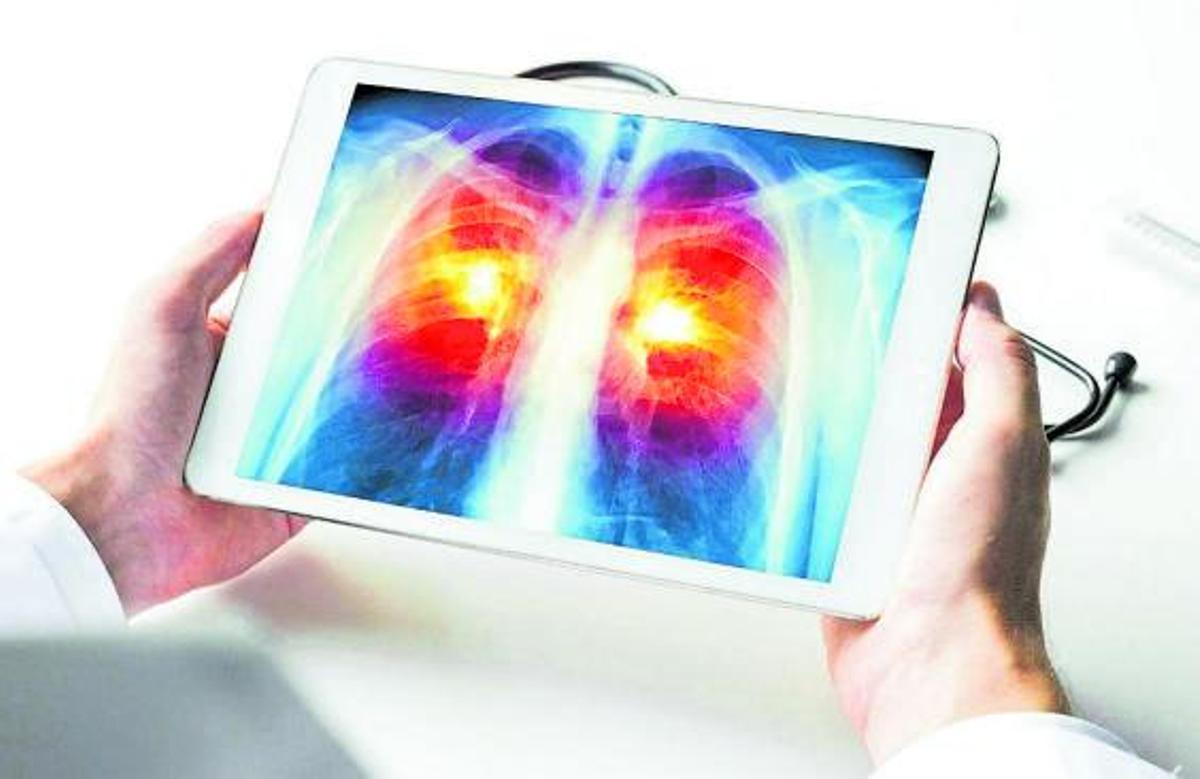 La quimio-inmunoterapia, eficaz en el cáncer pulmonar con metástasis ...