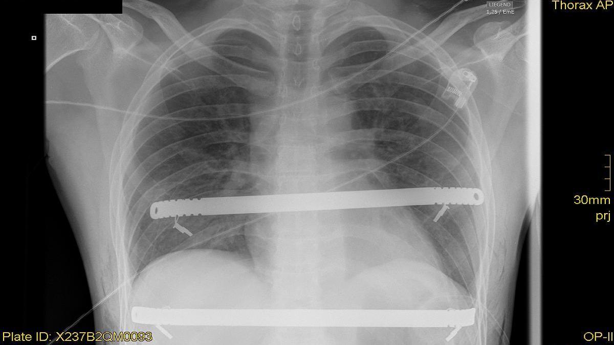 ¿Qué es el tórax excavado? ¿Es grave? ¿Cómo afecta y cómo se puede tratar?