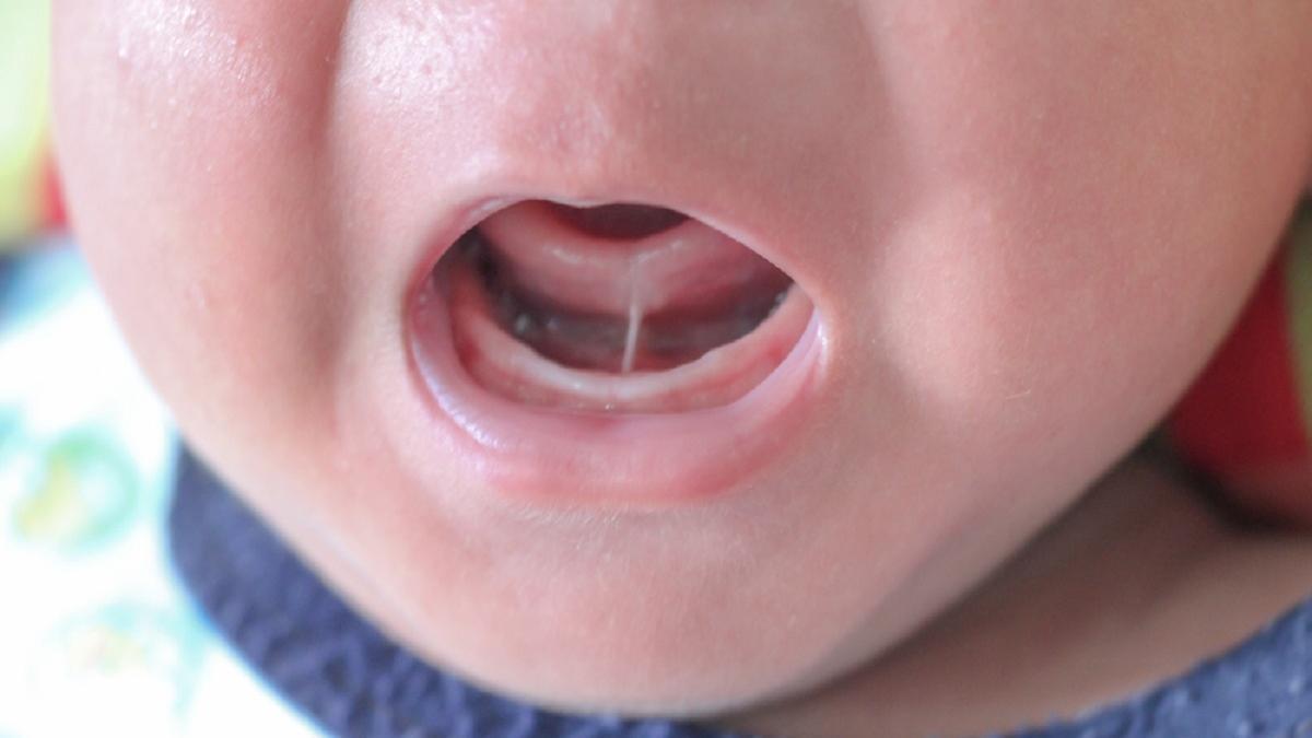 Los especialistas alertan de un exceso de cirugías del frenillo de los ...