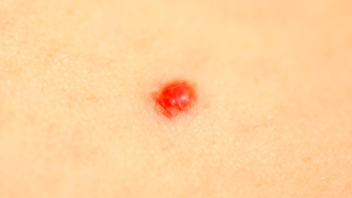 Tratamiento láser en Alicante para tratar puntos rubís, angiomas o rosácea