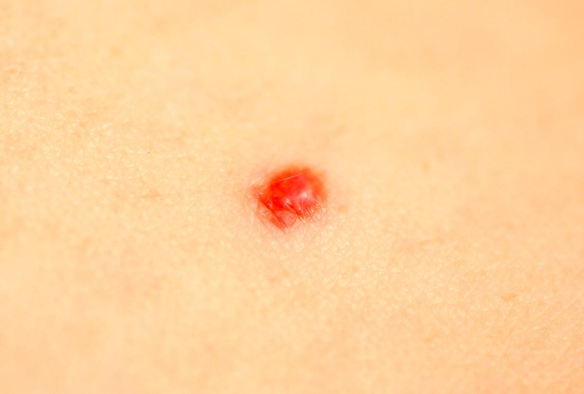 Tratamiento láser en Alicante para tratar puntos rubís, angiomas o rosácea