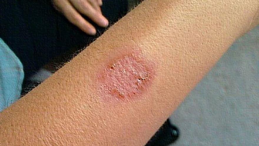 ÁNTRAX: Qué es, cómo se contagia, síntomas y mortalidad