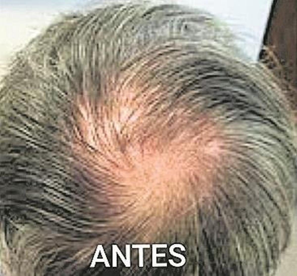 Marisa Tirado dispone de una Unidad Capilar para tratar distintas alopecias