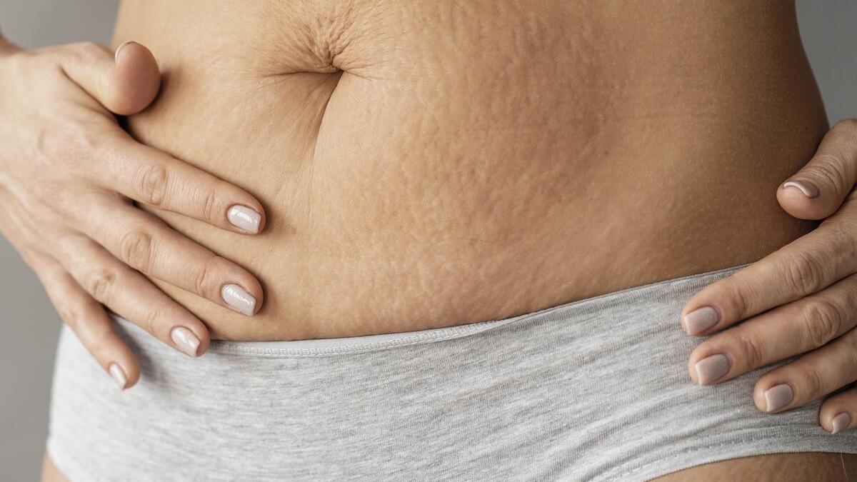 ¿Qué es el lipedema, la nueva enfermedad que afecta al 20% de las ...