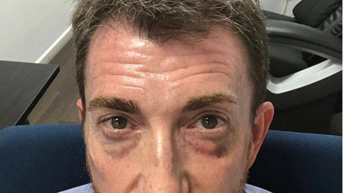 El moratón en el ojo de Pablo Motos