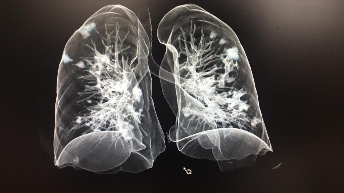 Imágenes en 3D de un pulmón con neumonía por coronavirus - La Provincia