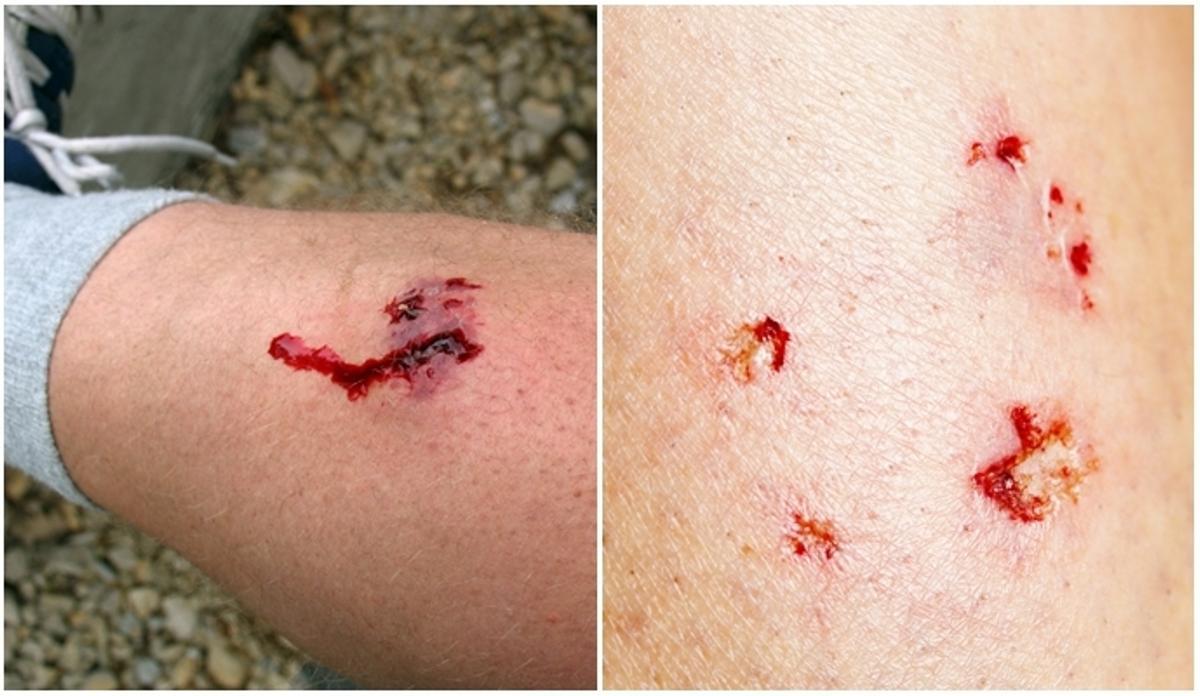 Heridas Por Mordedura De Perro Respuesta A Una Mordedura De Perro: