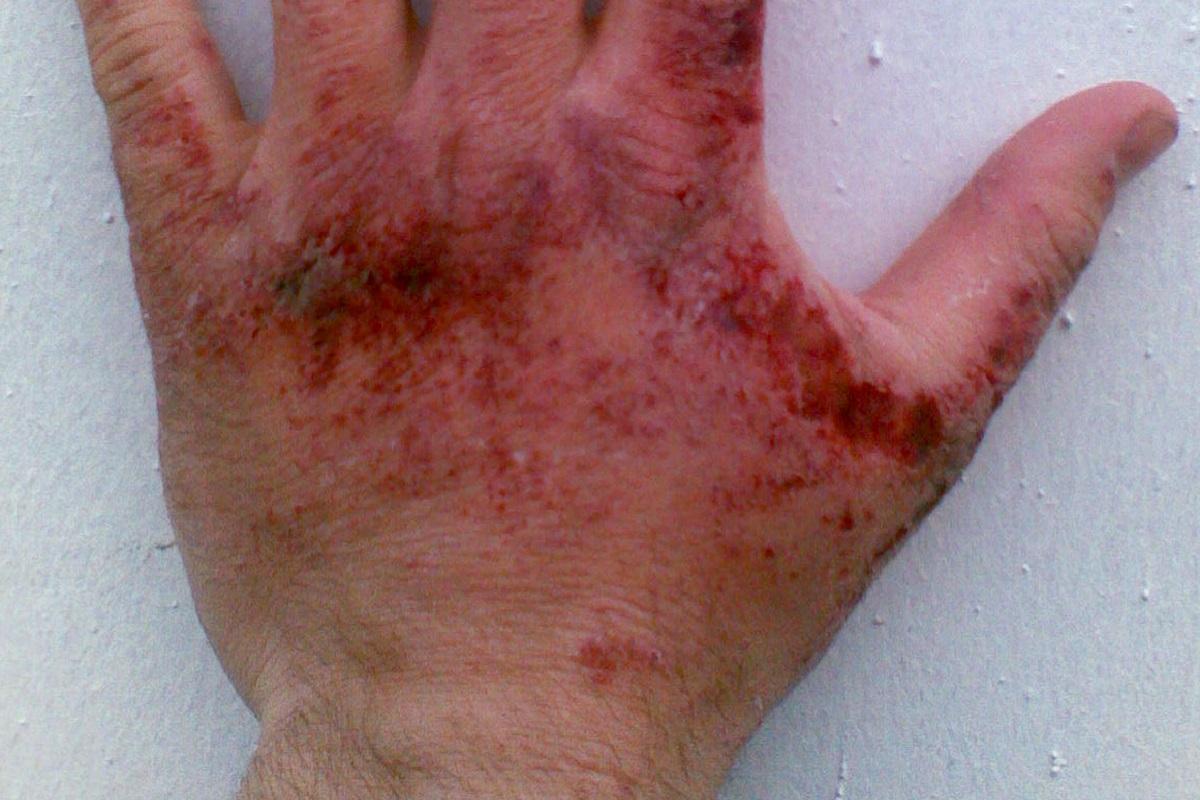 Quemaduras de primero, segundo y tercer grado ¿Cómo aprender a ...