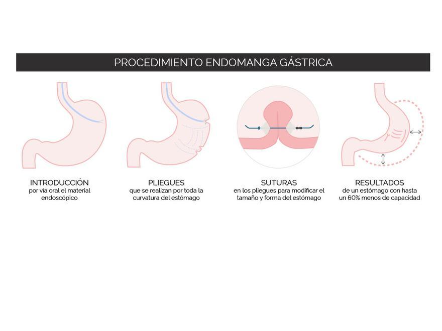 «La Endomanga reduce el volumen del estómago sin cicatrices y con una ...