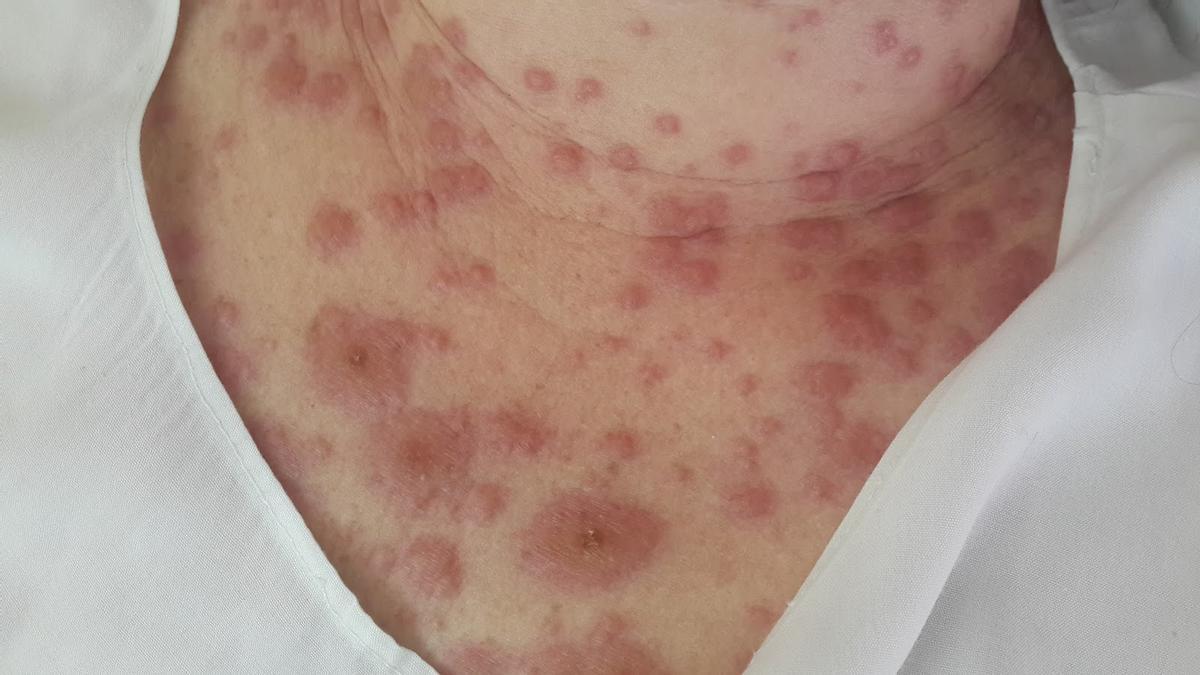 Fotos Eritema Multiforme: ¿Urticaria o nuevo efecto de la vacuna del covid?