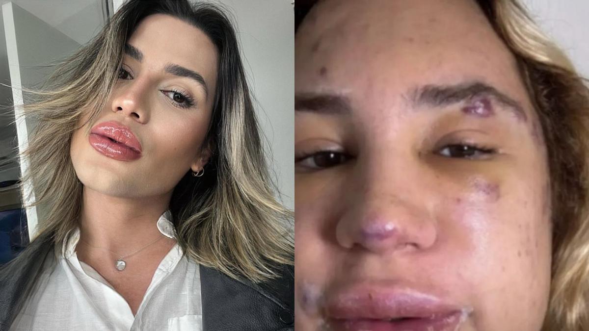 Fallece Adair Mendes, influencer de 31 años, tras someterse a la cirugía conocida como 'foxy eyes'